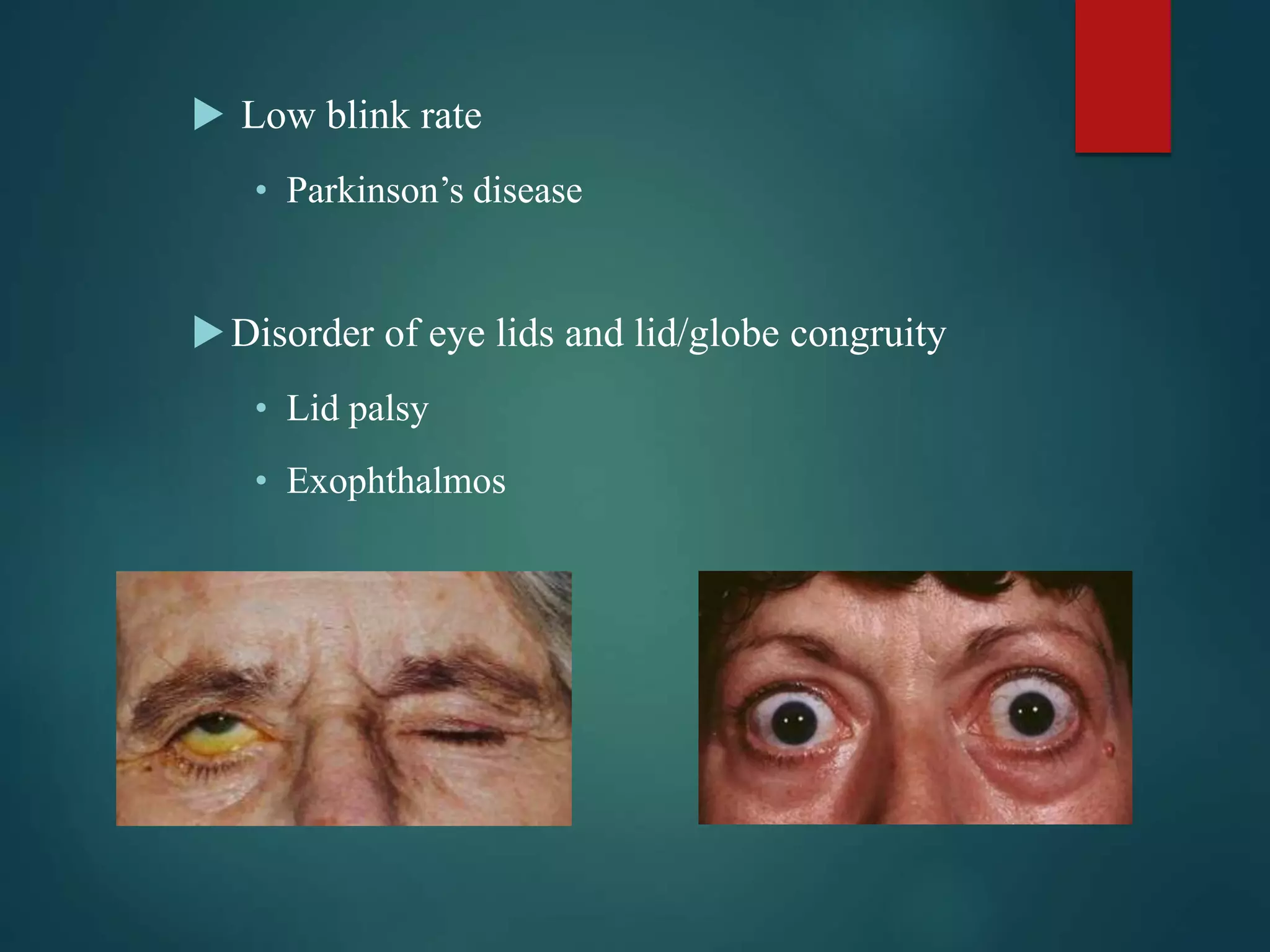 Dry eye pathology | PPTX
