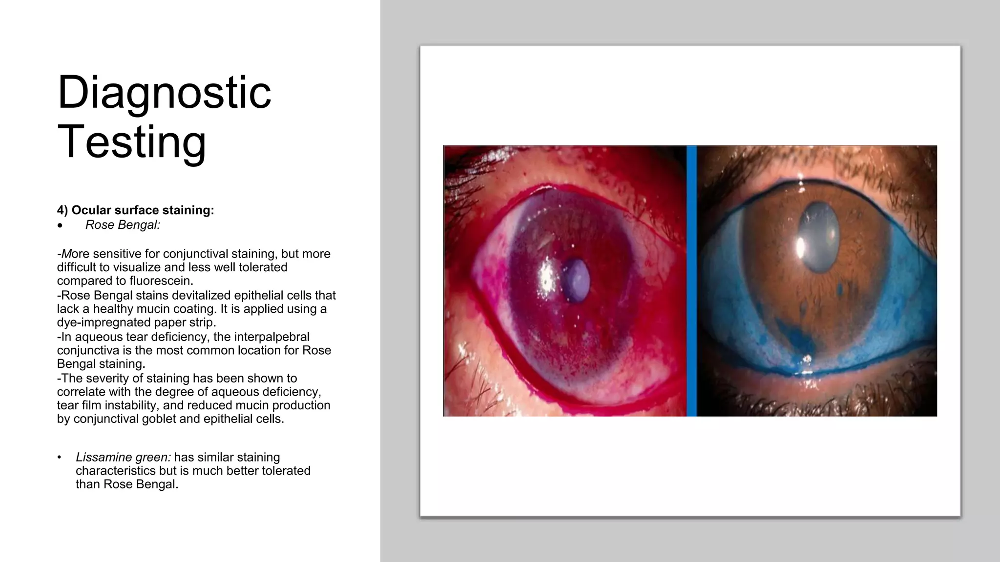 Dry Eye Syndrome 33.pptx