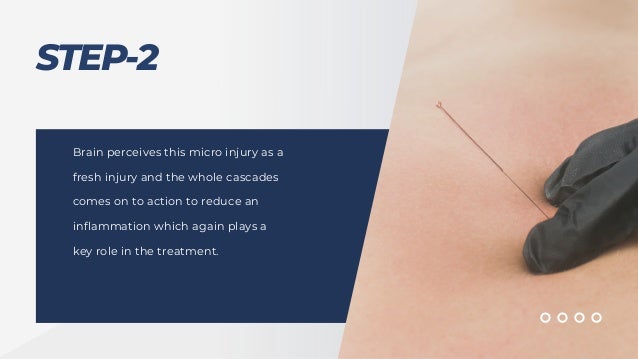 Dry Needling Therapy Reasons and Benefits.pdf