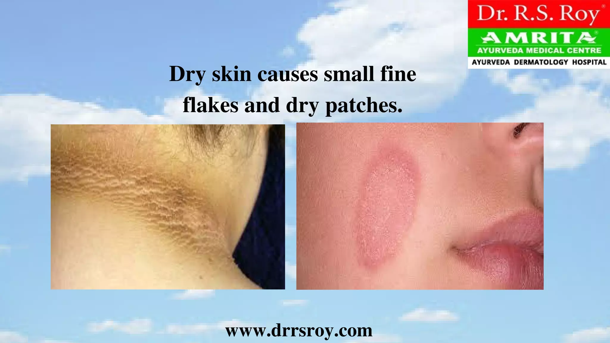 Dry Skin Ayurvedic Treatment In Kerala | Skin Disease Treatment In ...