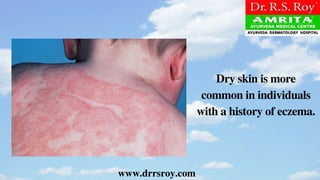 Dry Skin Ayurvedic Treatment In Kerala | Skin Disease Treatment In ...