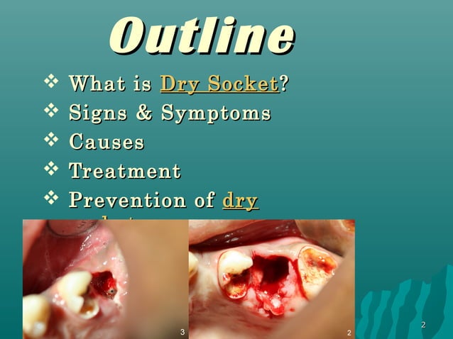 Dry socket | PPT