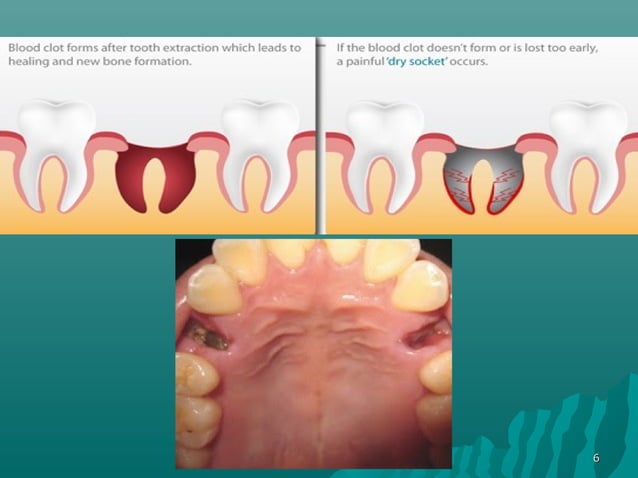 Dry socket | PPT