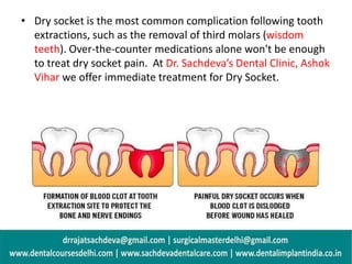 Dry socket | PPTX