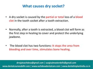 Dry socket | PPTX