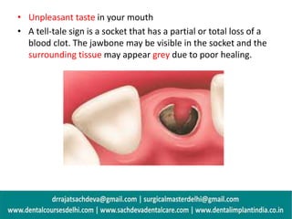 Healthy Socket After Extraction