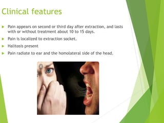 Dry socket | PPTX
