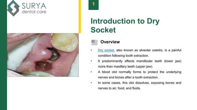 Dry Socket vs Normal Socket - Surya Dental Care | PPT