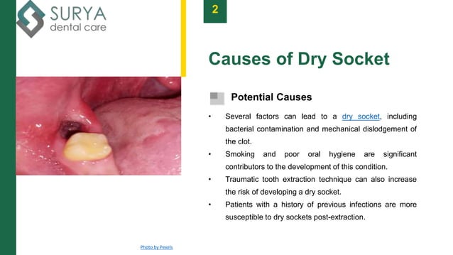 Dry Socket vs Normal Socket - Surya Dental Care | PPT