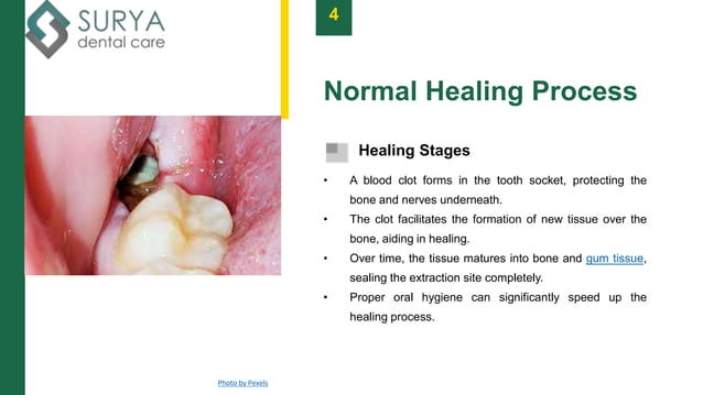 Dry Socket vs Normal Socket - Surya Dental Care | PPT