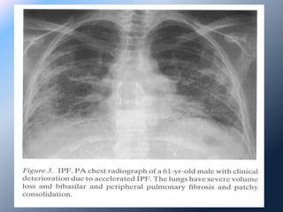 Diffue Parenchymal Lung Disease (DPLD) , Lymphangioleomyomatosis , Lung ...