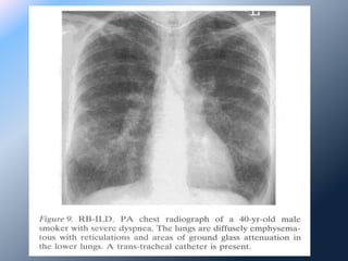 Diffue Parenchymal Lung Disease (DPLD) , Lymphangioleomyomatosis , Lung ...