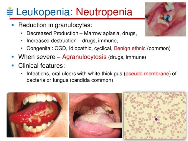 Haematology for Dental Students - WBC Disorders