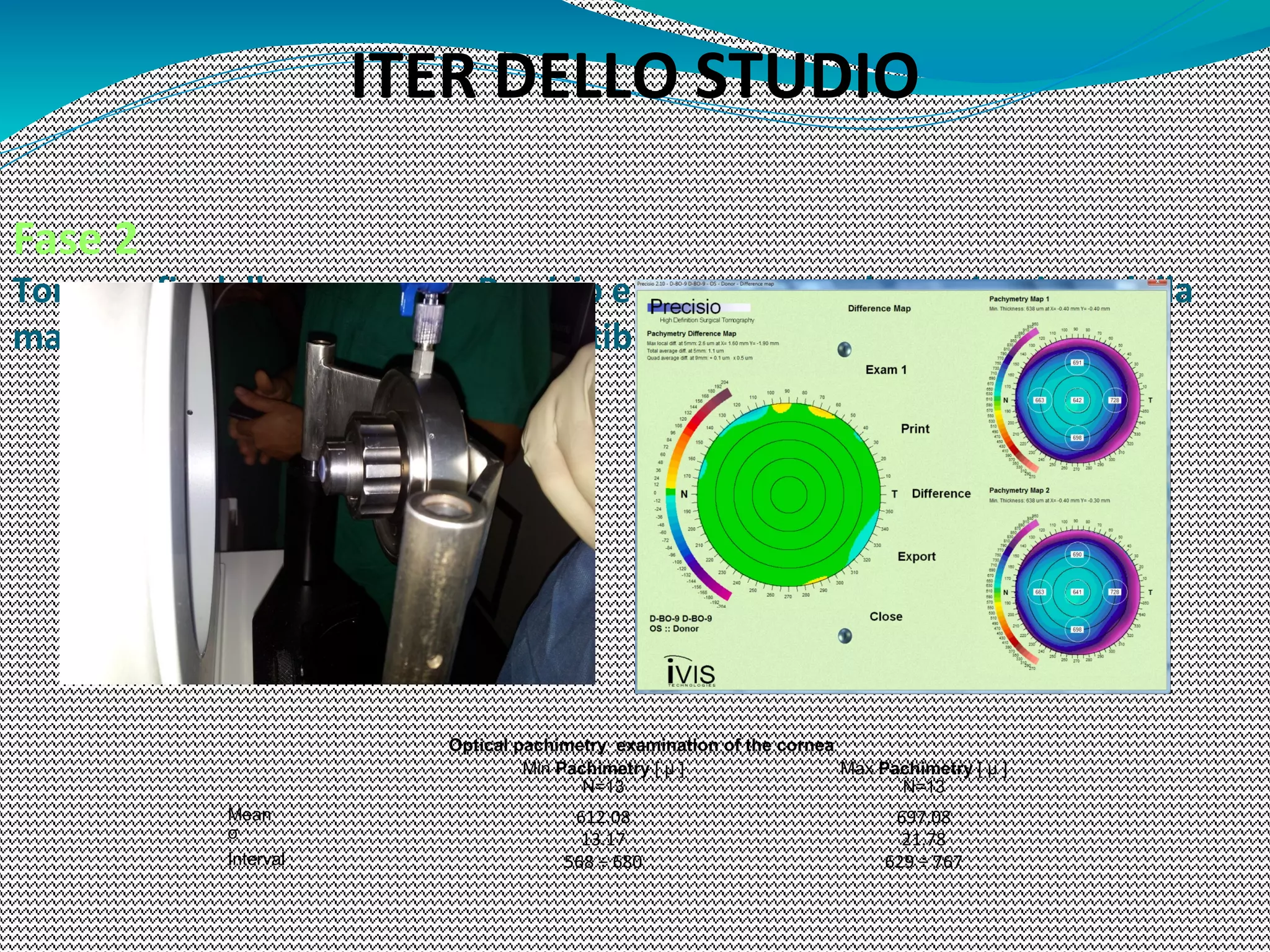 Banca delle cornee e trapianto (cheratoplastica) endoteliale: presente ...