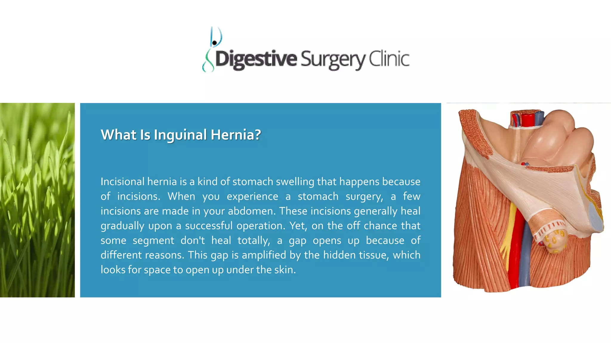 All about Inguinal Hernia | PDF | Digestive Disorders | Diseases and ...