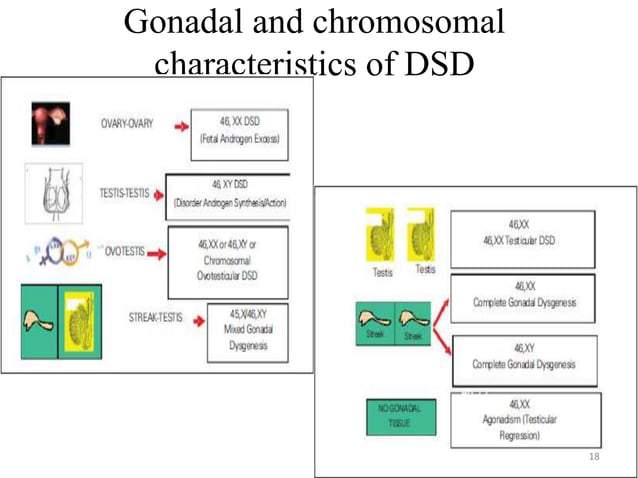 Approach to DSD (Ambiguous genitalia) | PPTX | Endocrine and Metabolic ...