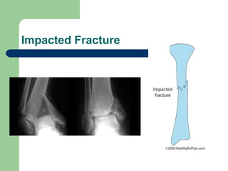 Deanna Shippee Fractures Ppt | PPT