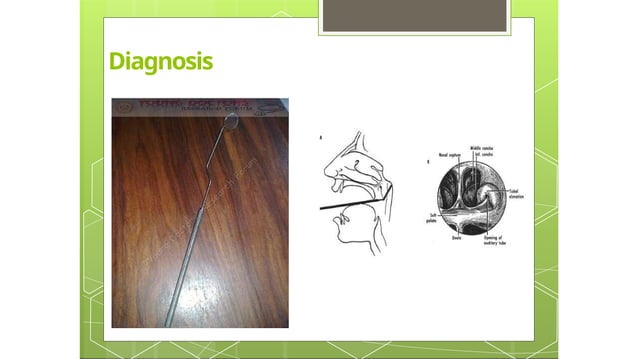 Adenoid_Hypertrophy_-1.pptx for medical student | PPTX | Ear, Nose and Throat Conditions ...