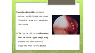 Adenoid_Hypertrophy_-1.pptx for medical student | PPTX | Ear, Nose and ...