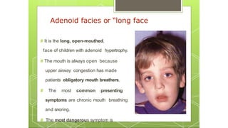 Adenoid_Hypertrophy_-1.pptx for medical student | PPTX