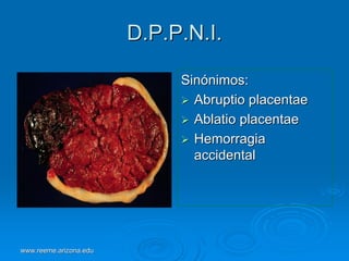 Dsprendimiento de placenta normoinserta | PDF