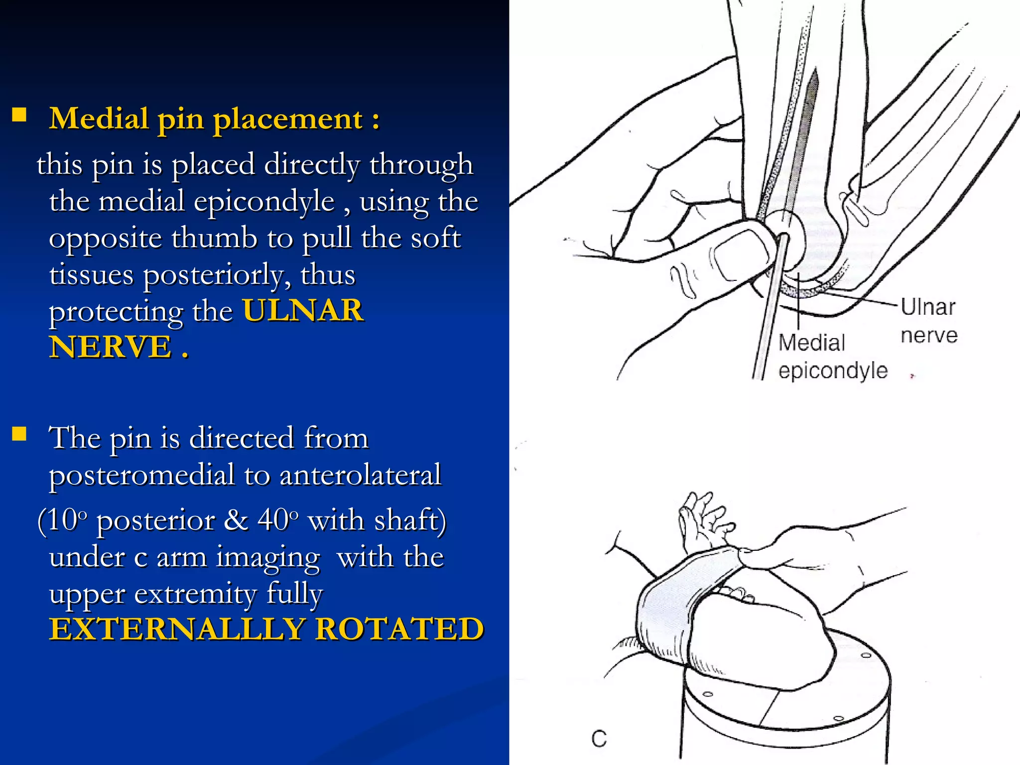 D) supracondylar fracture | PPT