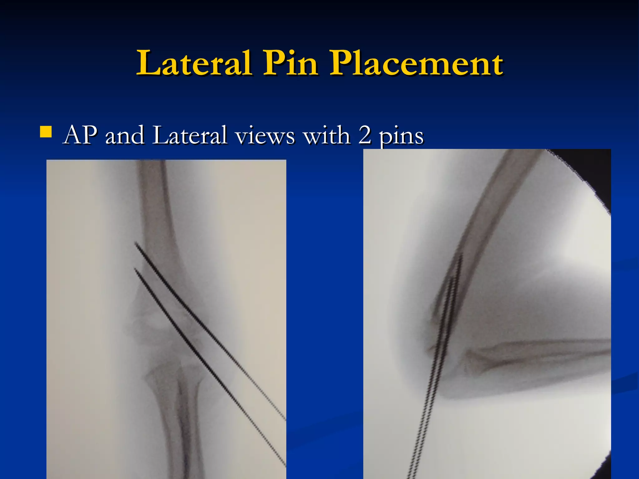D) supracondylar fracture | PPT
