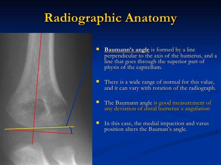 D) supracondylar fracture