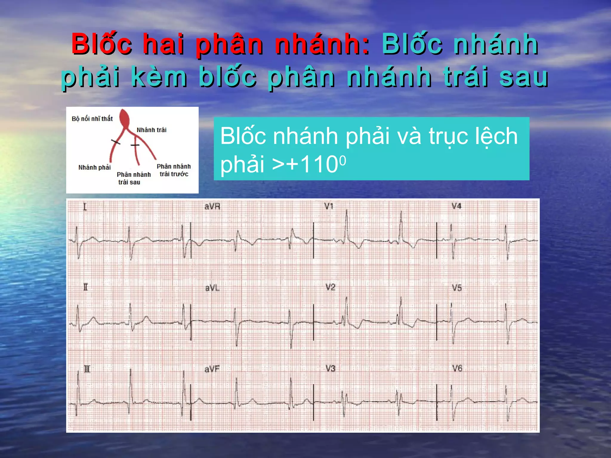 ECG - Types of Block | PPT