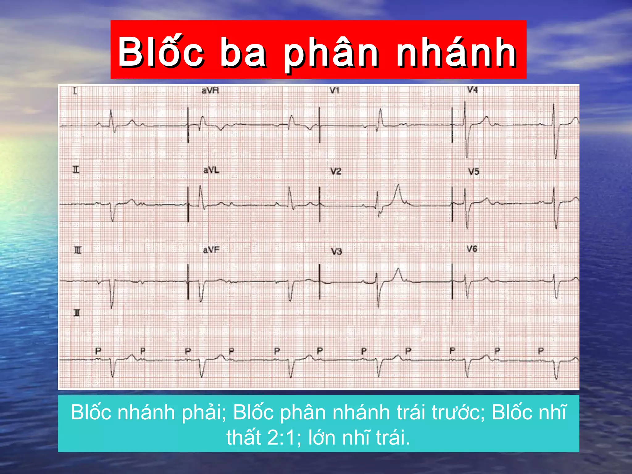 ECG - Types of Block | PPT