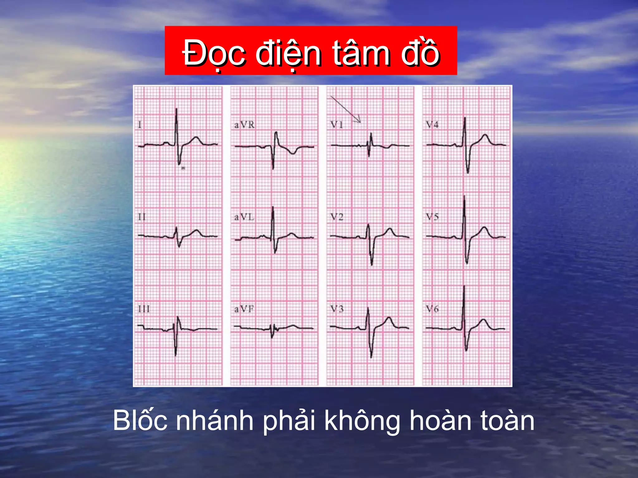 ECG - Types of Block | PPT