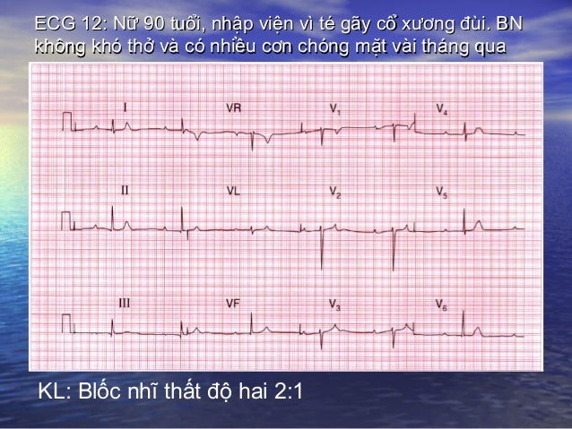 ECG - Types of Block