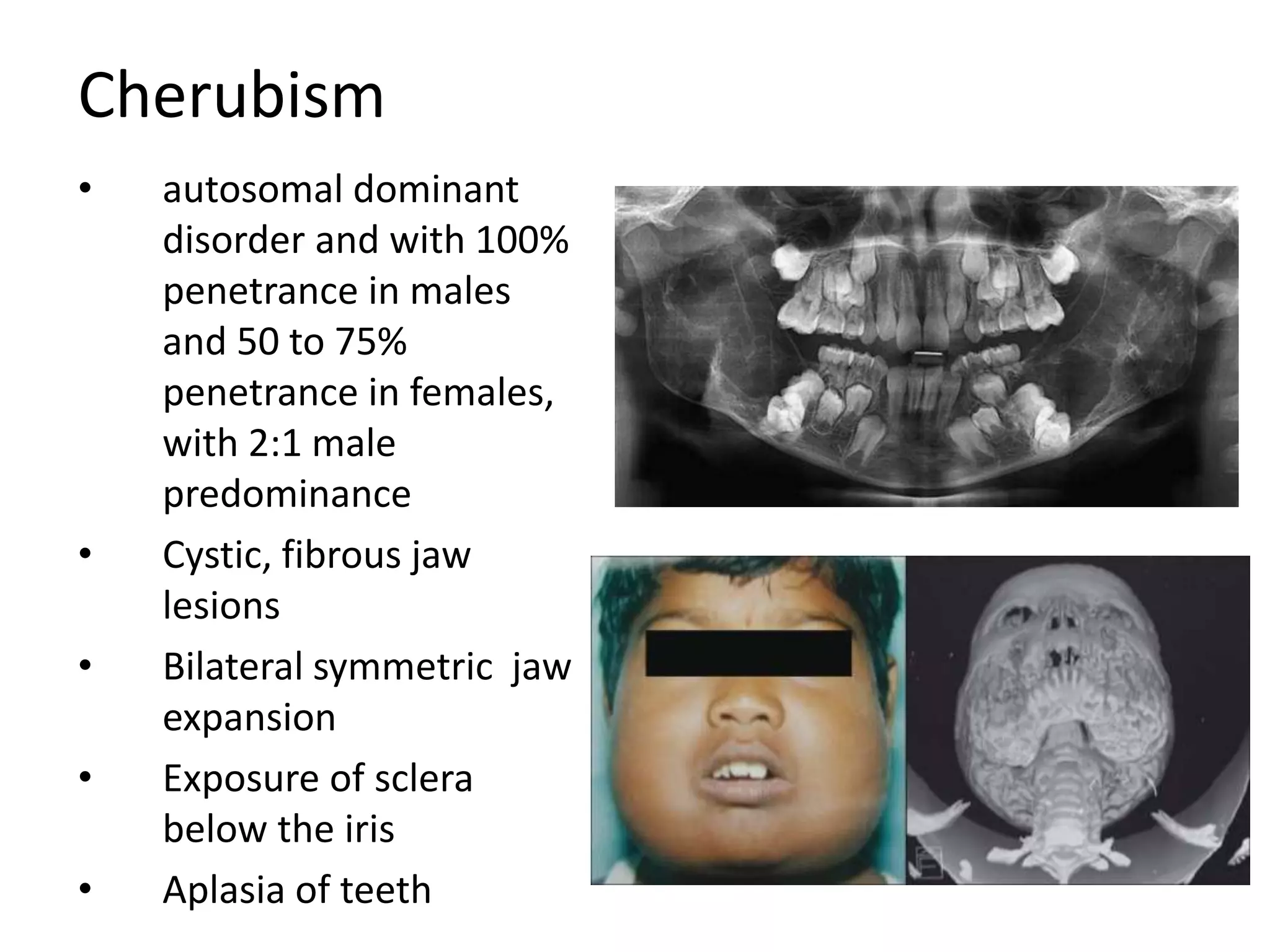 delay tooth eruption | PPTX