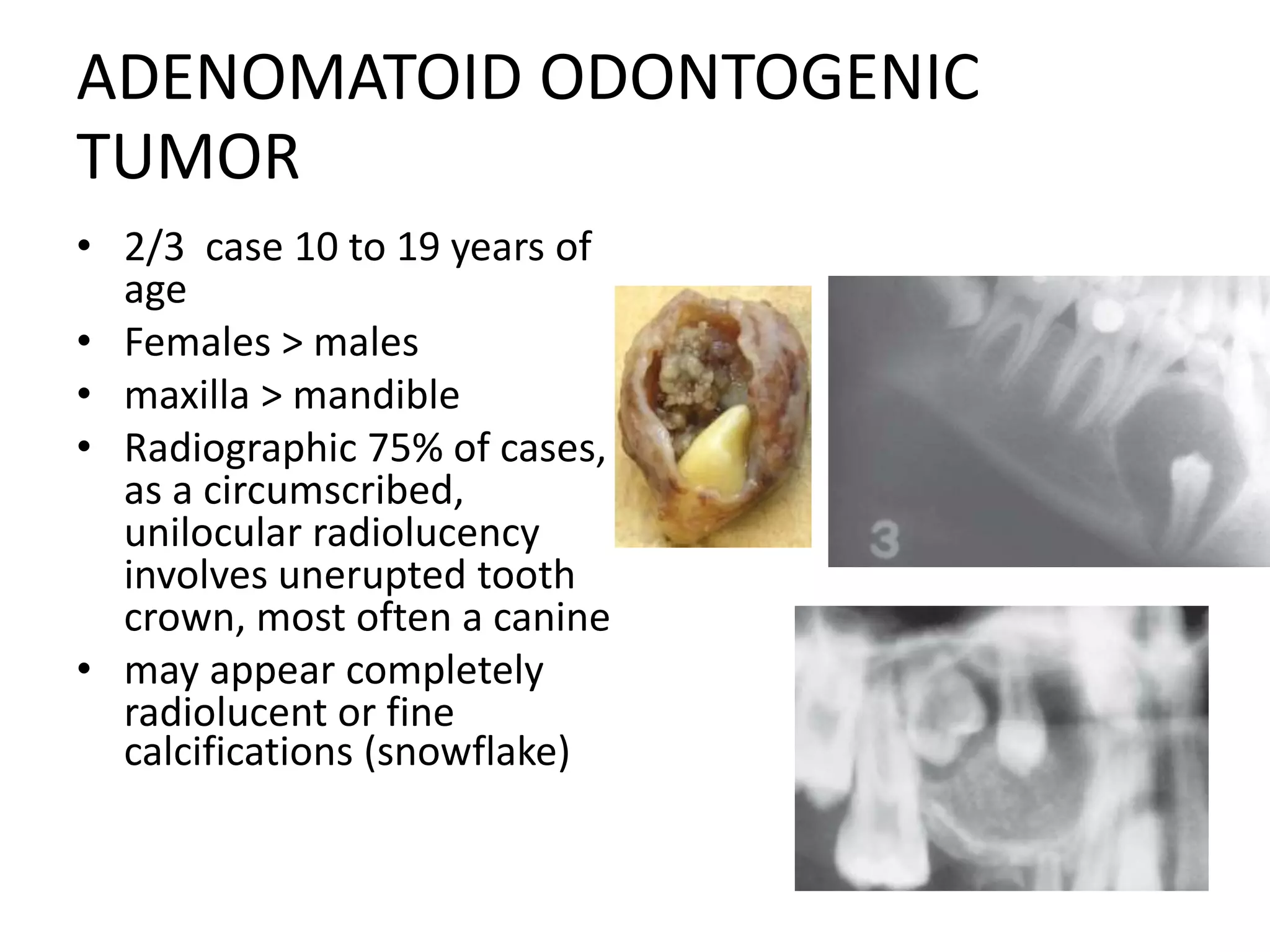 delay tooth eruption | PPTX