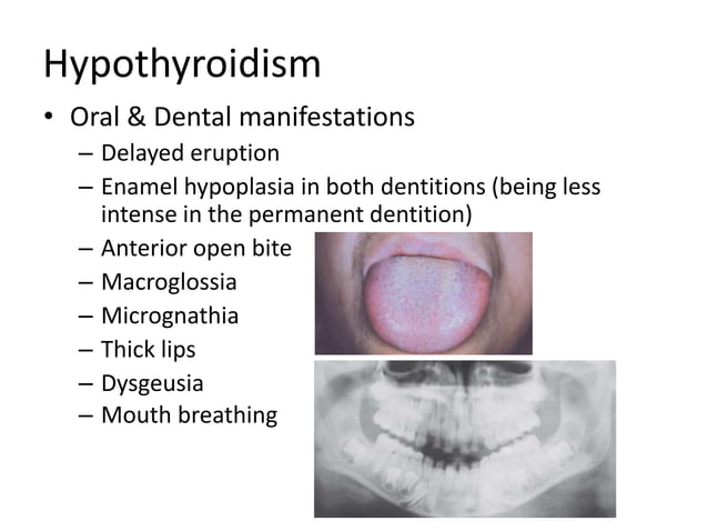 delay tooth eruption | PPTX | Dental Health | Diseases and Conditions