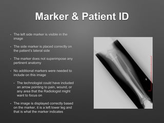D torres lower_leg_oralppt3 | PPTX