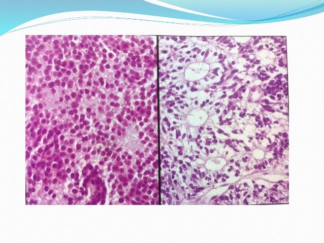 Tumors And Tumor Like Conditions Of Nasal Cavity