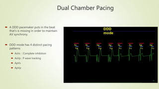 PM Dual chamber mode | PPT