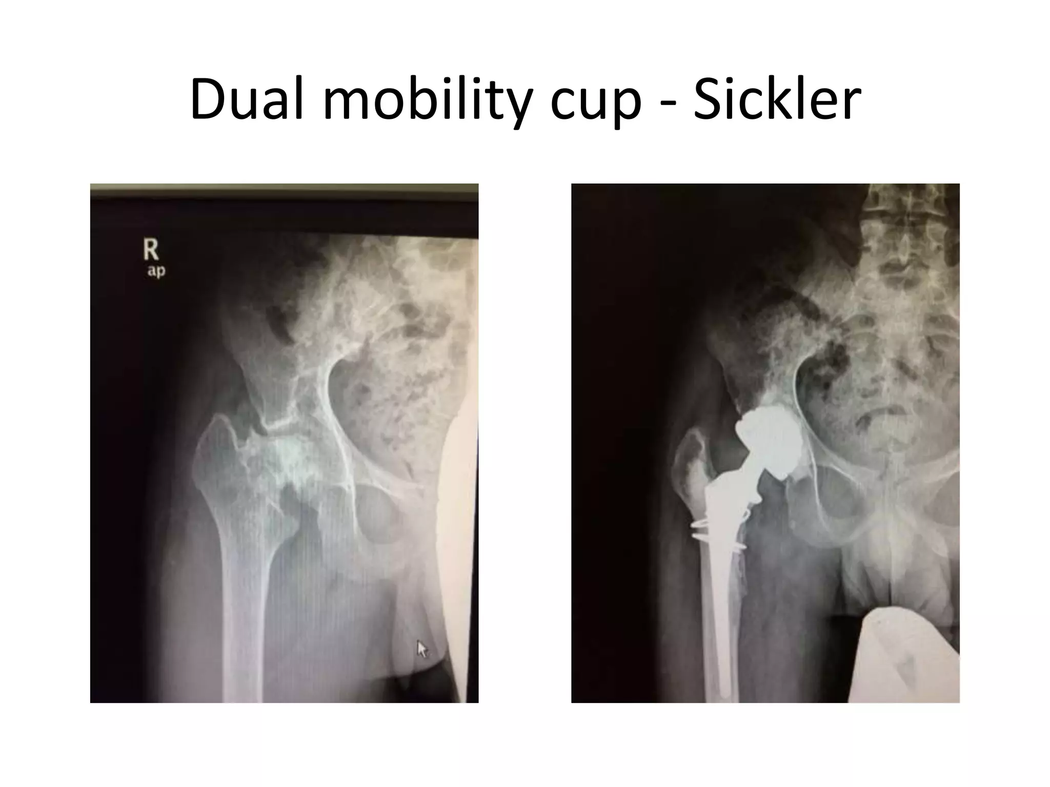 Dual mobility cups (6) | PPTX