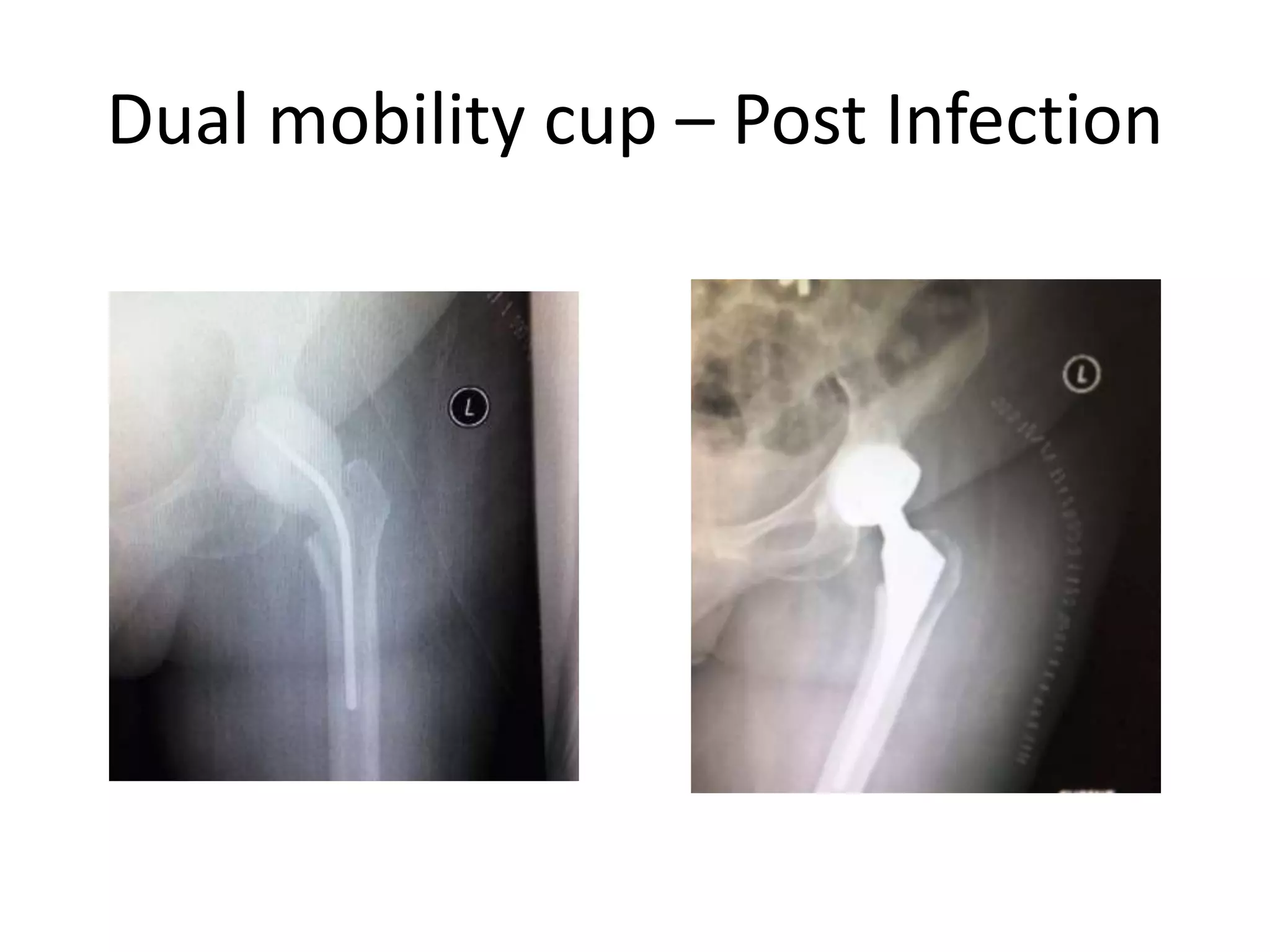 Dual mobility cups (6) | PPTX
