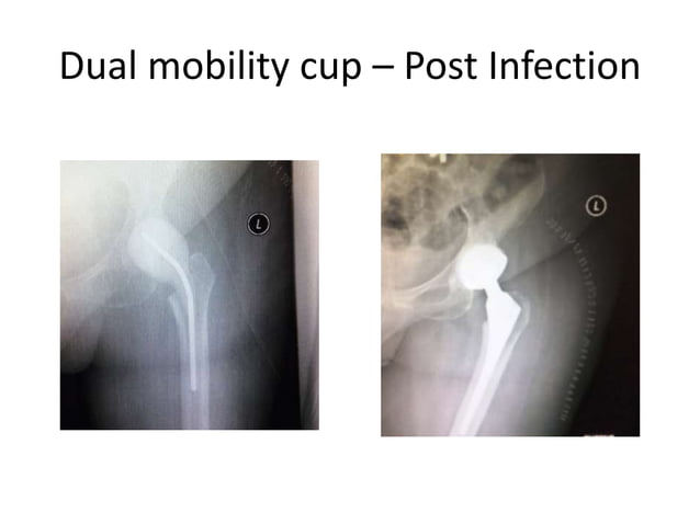 Dual Mobility Cups 6 Pptx