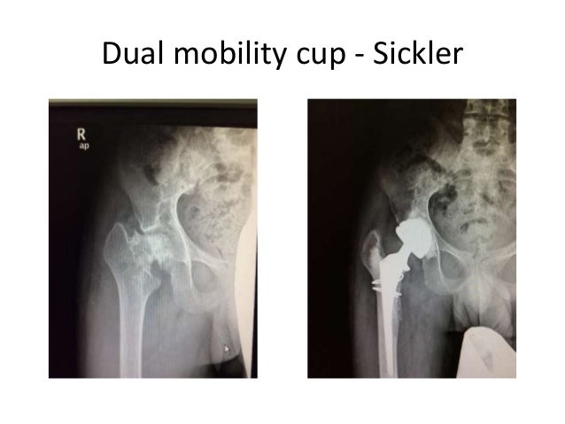 Dual Mobility Cups 6