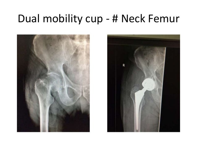 Dual Mobility Cups 6