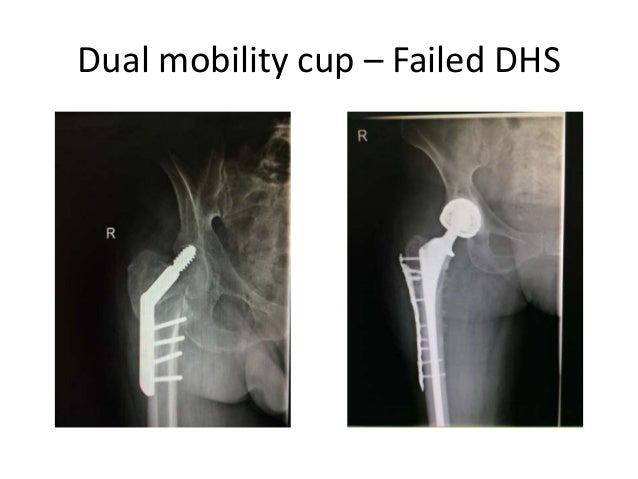 Dual Mobility Cups 6