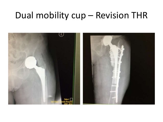 Dual Mobility Cups 6