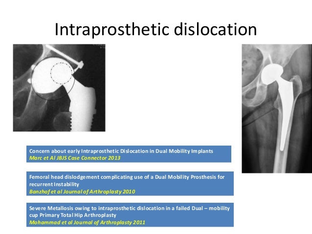 Dual Mobility Cups 6