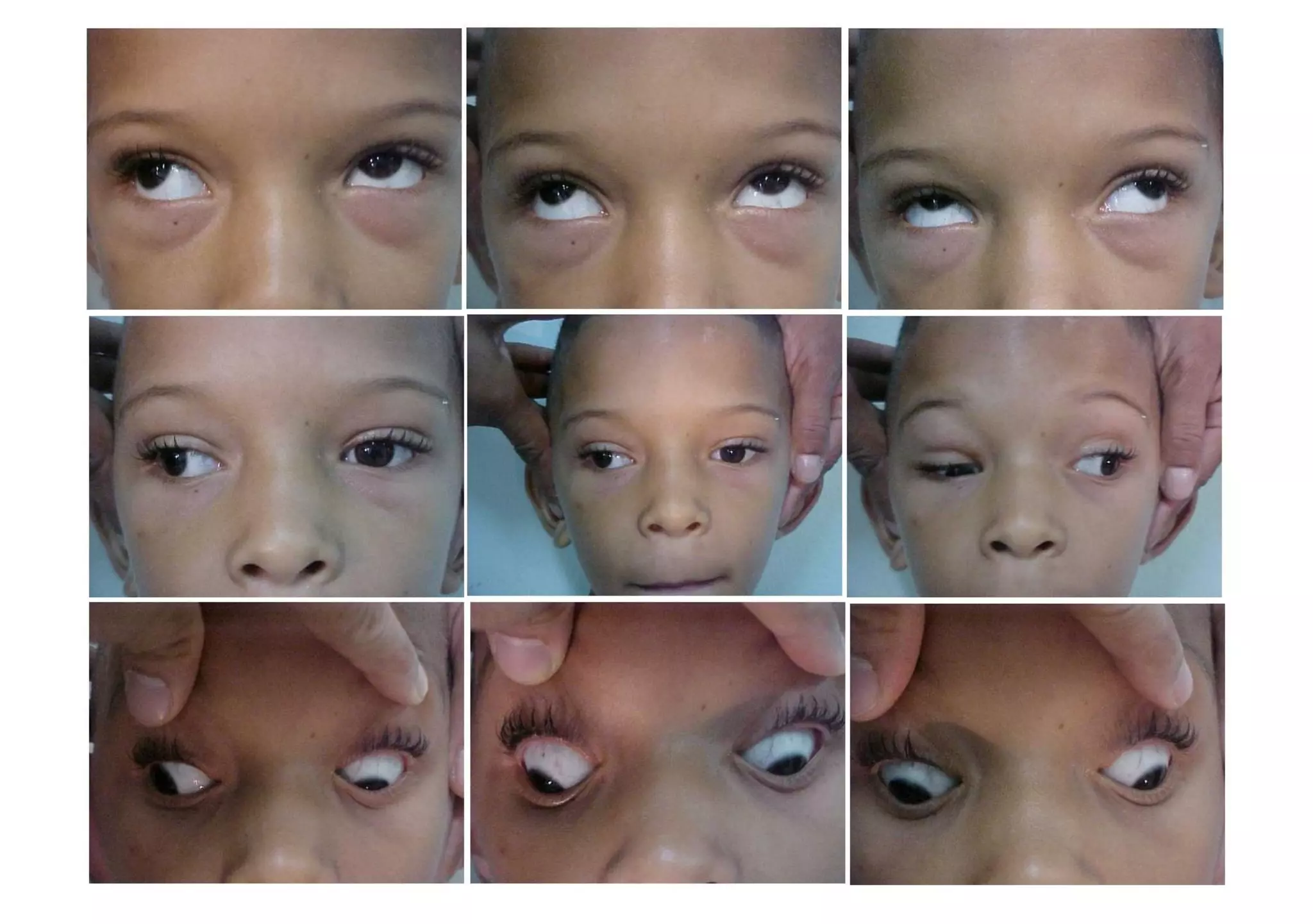 Duane Retraction Syndrome | PDF