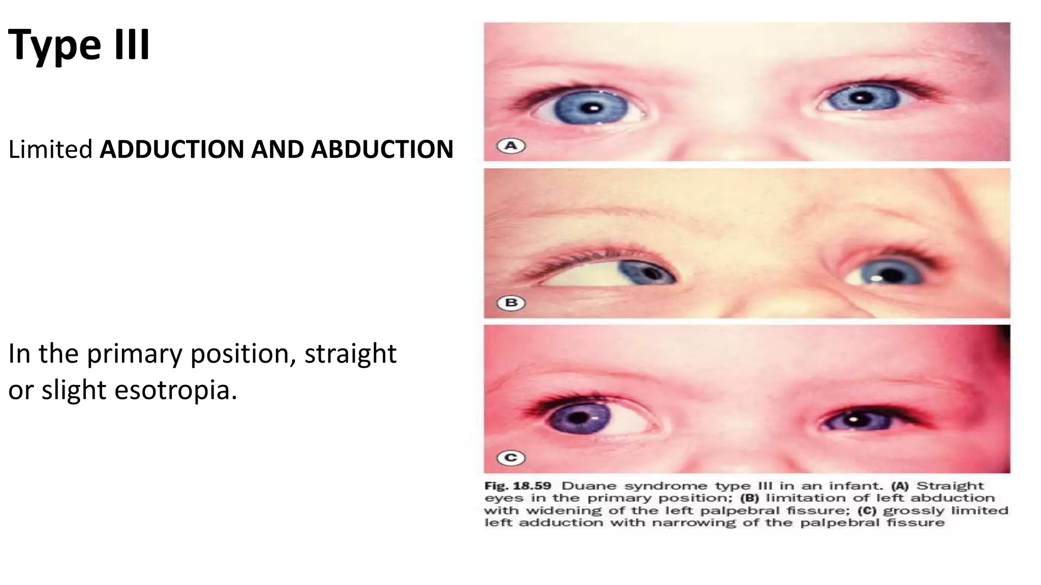 Duane Retraction Syndrome- Congenital Cranial Dysinnervation Disorder ...