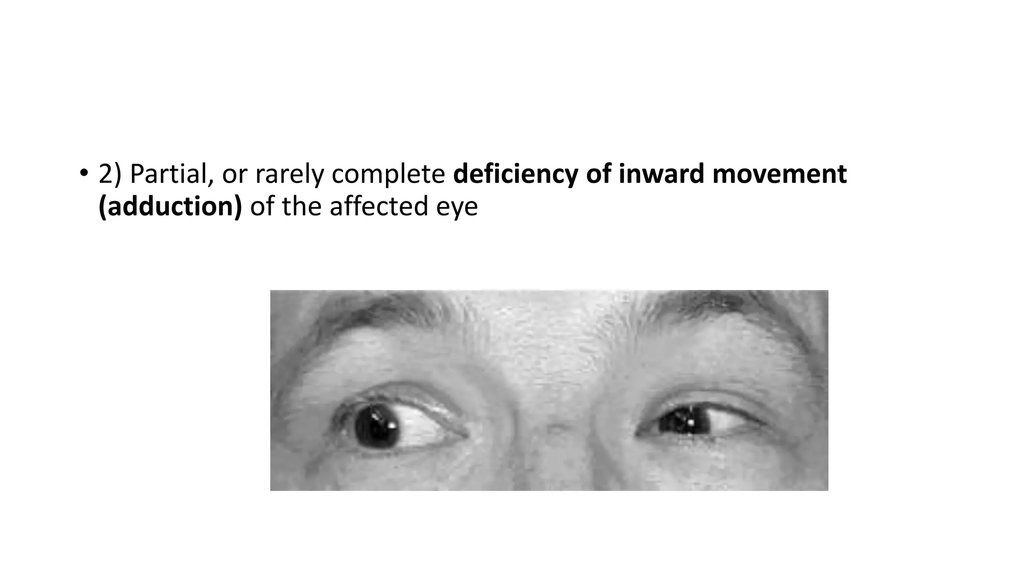 Duane Retraction Syndrome- Congenital Cranial Dysinnervation Disorder ...