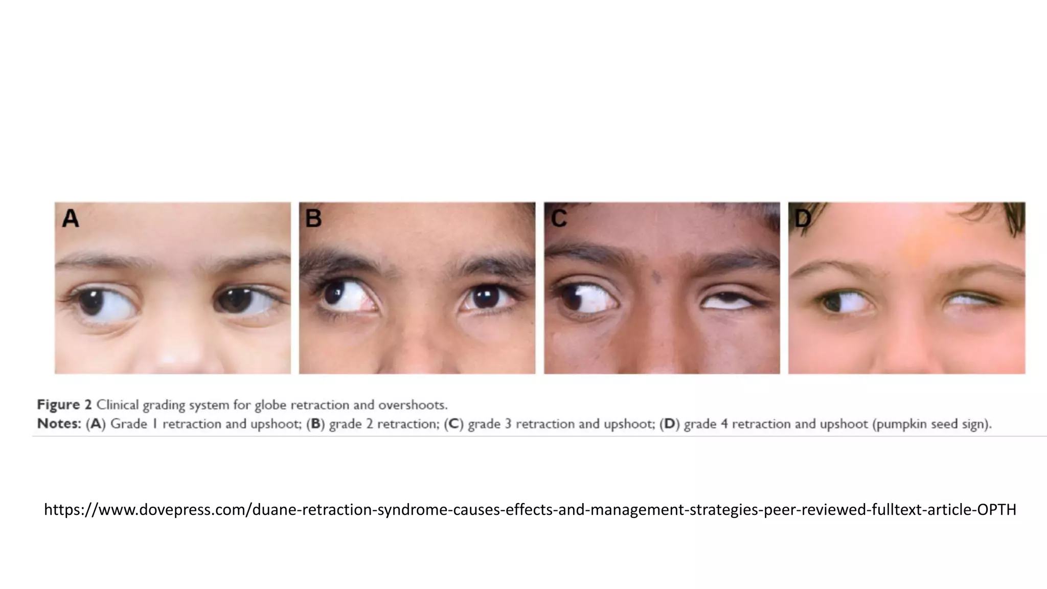 Duane Retraction Syndrome- Congenital Cranial Dysinnervation Disorder ...